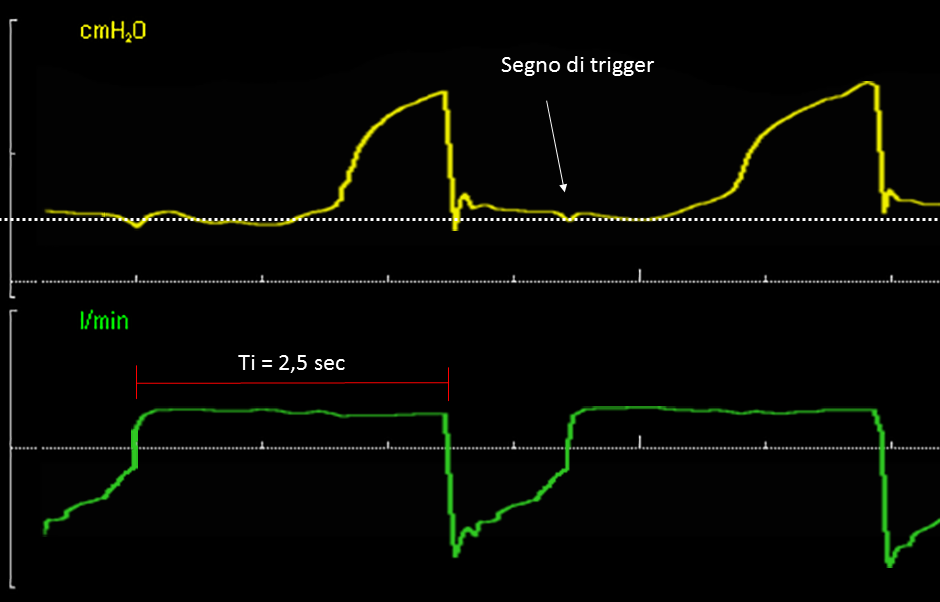 Volume Controlled Ventilation (parte 2) | Triggerlab