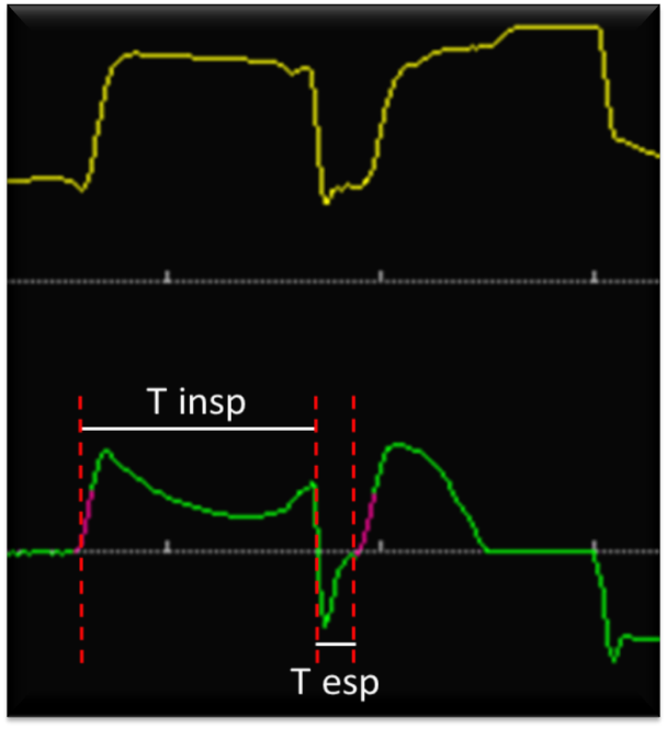 Doppio Trigger (Double Triggering or Breath Stacking) | Triggerlab