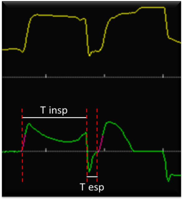 Doppio Trigger (Double Triggering or Breath Stacking) | Triggerlab