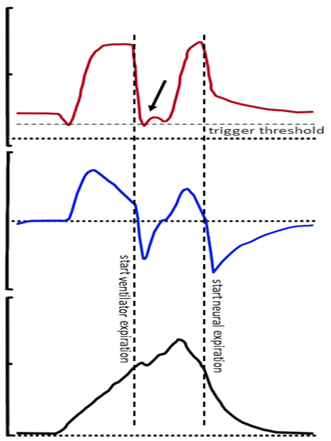 Doppio Trigger (Double Triggering or Breath Stacking) | Triggerlab