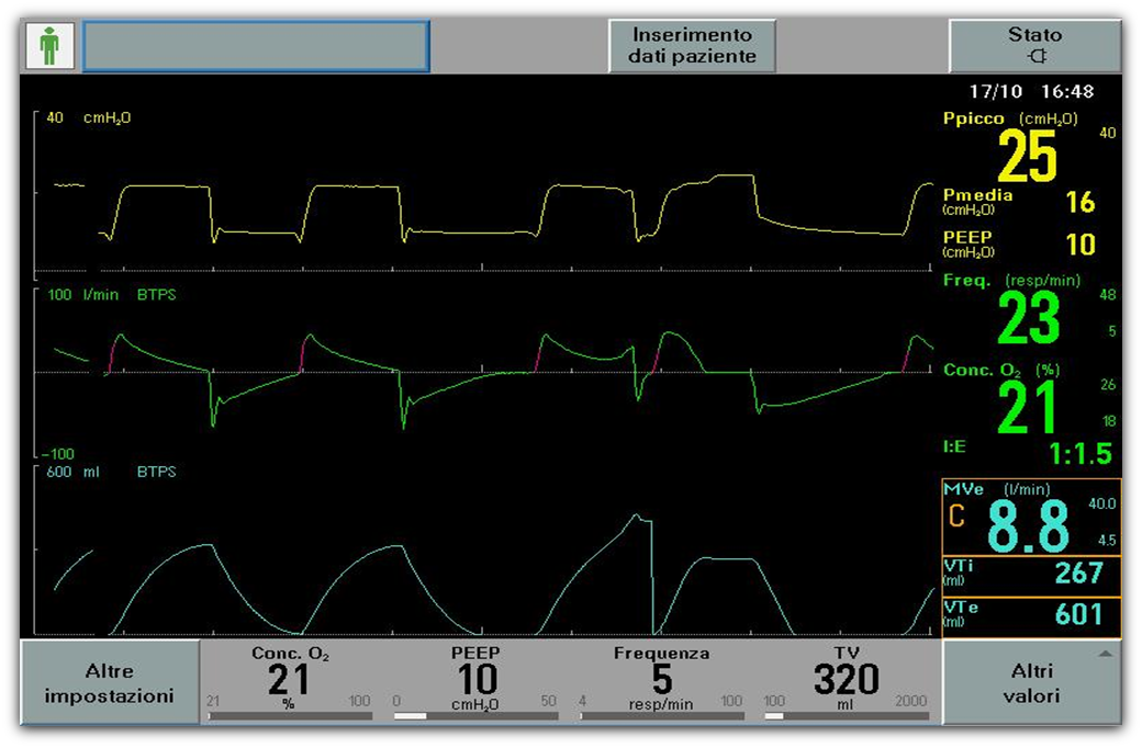 Doppio Trigger (Double Triggering or Breath Stacking) | Triggerlab