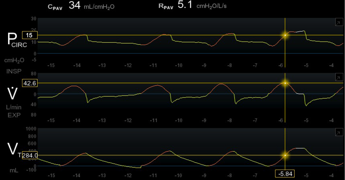 Proportional Assist Ventilation | Triggerlab