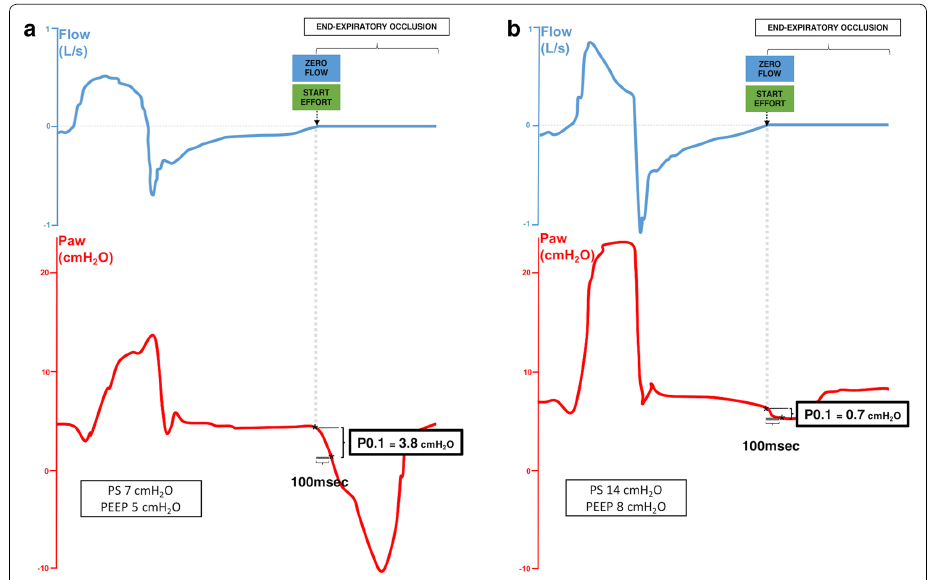 How to monitor inspiratory effort | Triggerlab