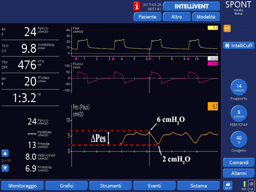 How to monitor inspiratory effort | Triggerlab