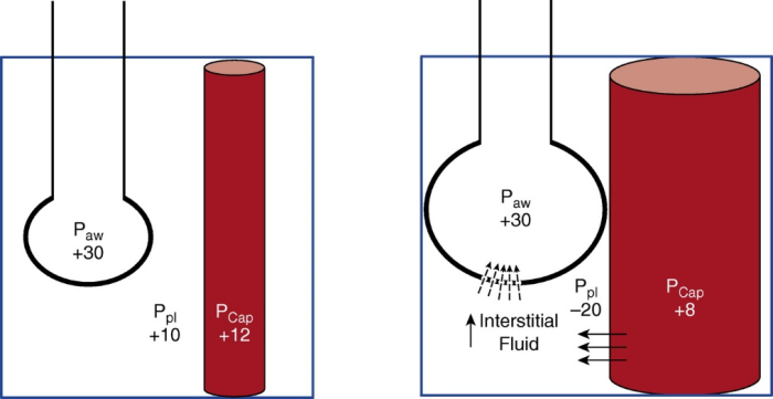 Patient Self-Inflicted Lung Injury (P-SILI) part 1 | Triggerlab