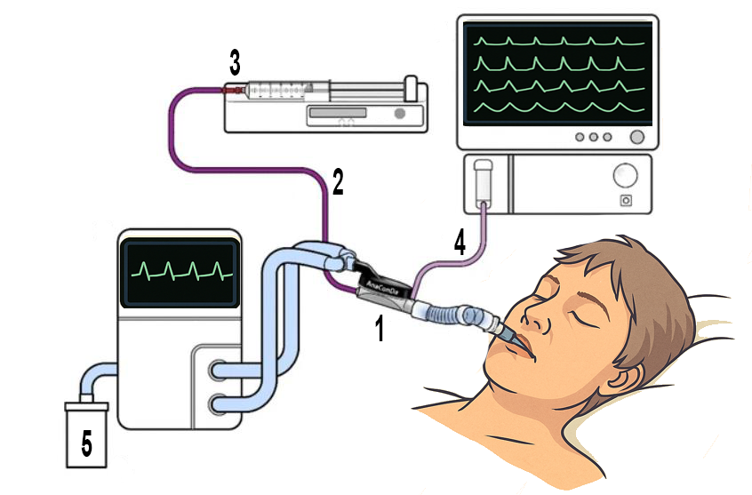 ANESTETICI INALATORI IN TERAPIA INTENSIVA | Triggerlab